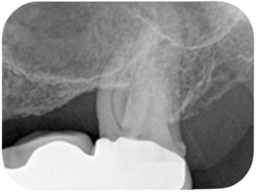 Mechanical Preparation – Komet Dental