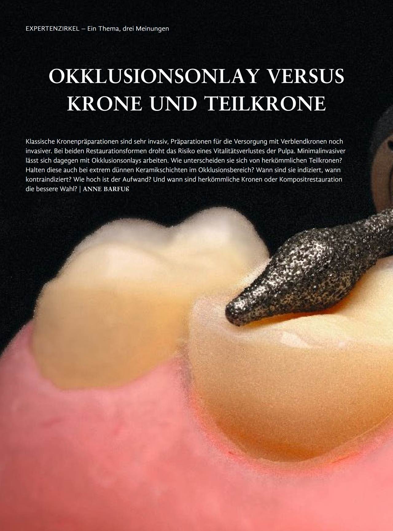 FB | Okklusionsonlay versus Krone und Teilkrone – Komet Dental
