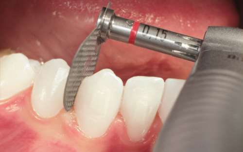 Save time and effort during interproximal enamel reduction: With the ...
