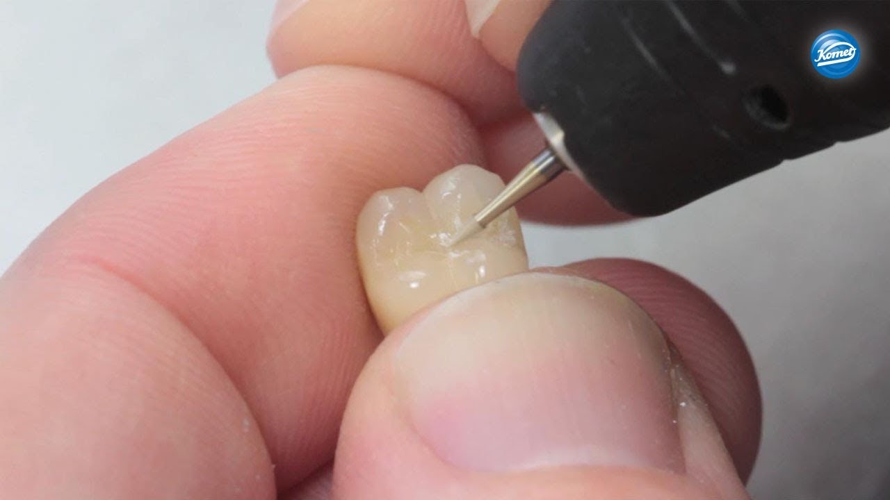 Vidéo | Façonnage de la surface occlusale d'une couronne latérale à ...