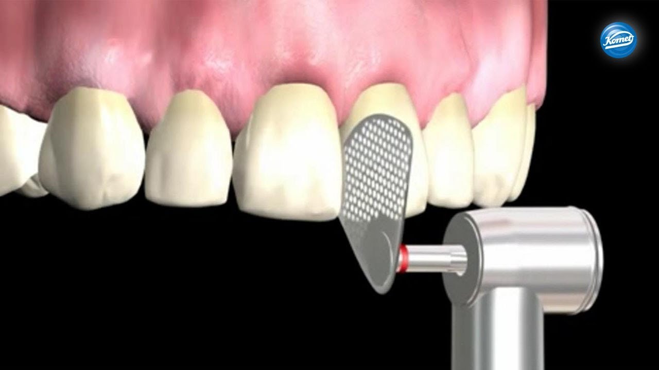 Vídeo | Reducción interdental del esmalte con discos oscilantes – Komet ...