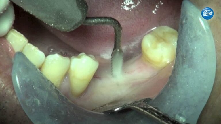 Manual reprocessing of semi-critical instruments › Komet Dental