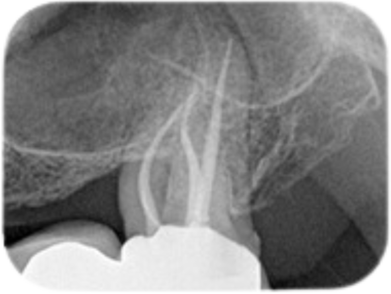 Mechanical Preparation – Komet Dental