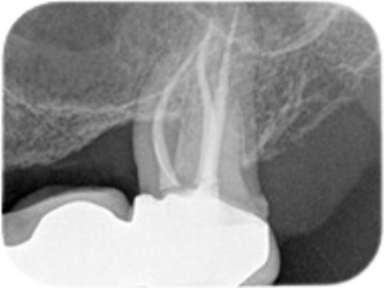 Mechanical Preparation – Komet Dental