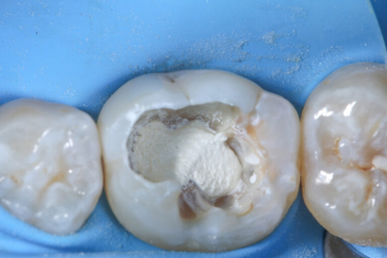 Procedure Endodontics – Komet Dental