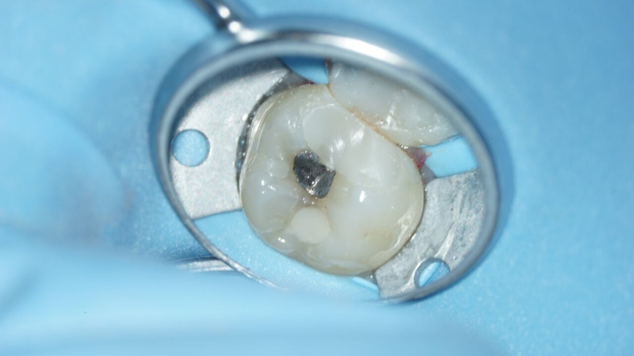 Case study: Endodontic treatments with Komet's FQ File System – Komet ...