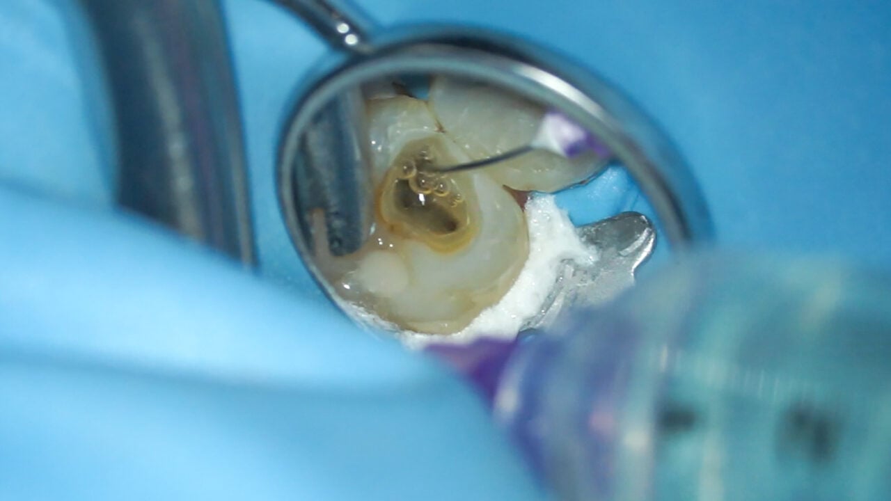 Case study: Endodontic treatments with Komet's FQ File System – Komet ...