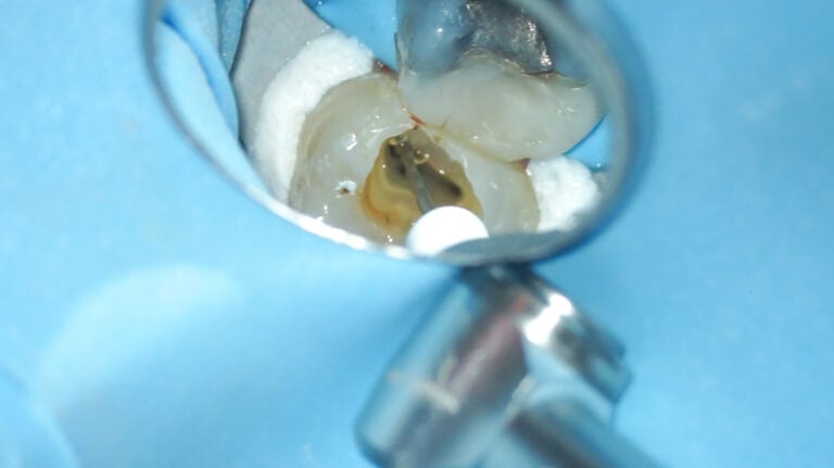 Mechanical Preparation – Komet Dental
