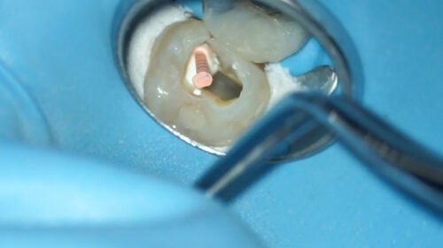 Case study: Endodontic treatments with Komet's FQ File System › Komet ...