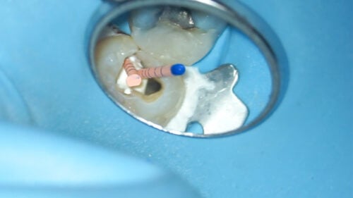 Case study: Endodontic treatments with Komet's FQ File System › Komet ...