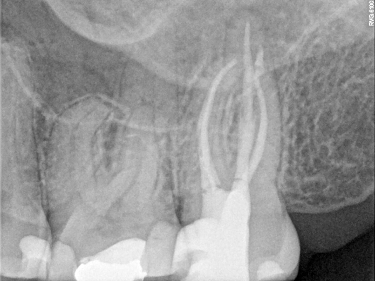 Case study: Endodontic treatments with Komet's FQ File System › Komet ...