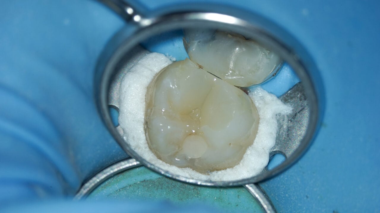 Case study: Endodontic treatments with Komet's FQ File System – Komet ...