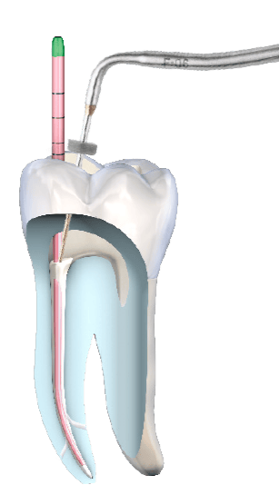 Obturation › Komet Dental