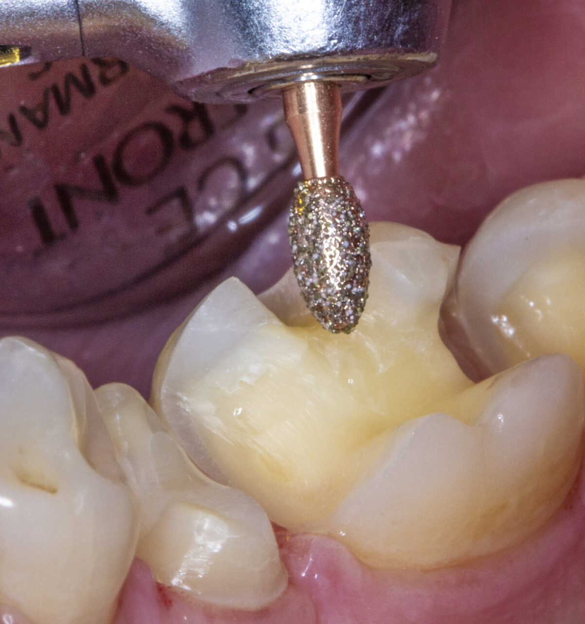 Cavity Preparation › Komet Dental