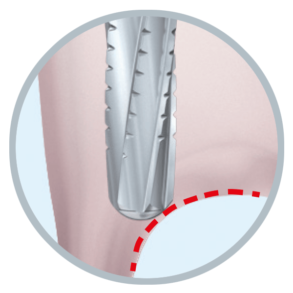Access Cavity › Komet Dental